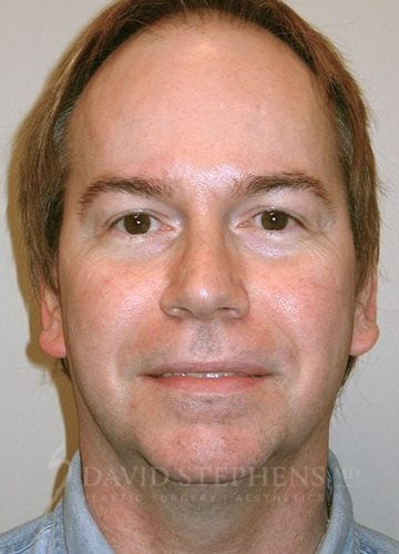 Face Lift Archives | Dr. David Stephens, Plastic Surgery | Medical ...
