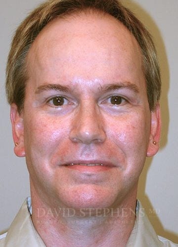 Face Lift Archives | Dr. David Stephens, Plastic Surgery | Medical ...