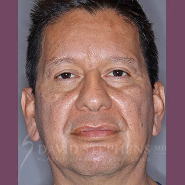 HALO Patient 08 | Dr. David Stephens